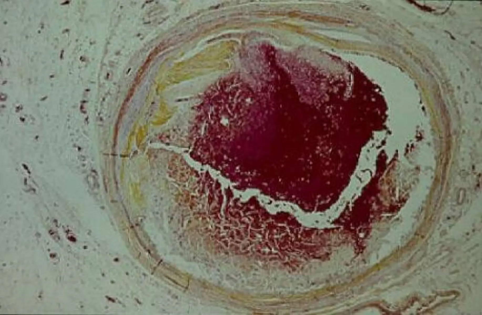 Significado de «ateroma»