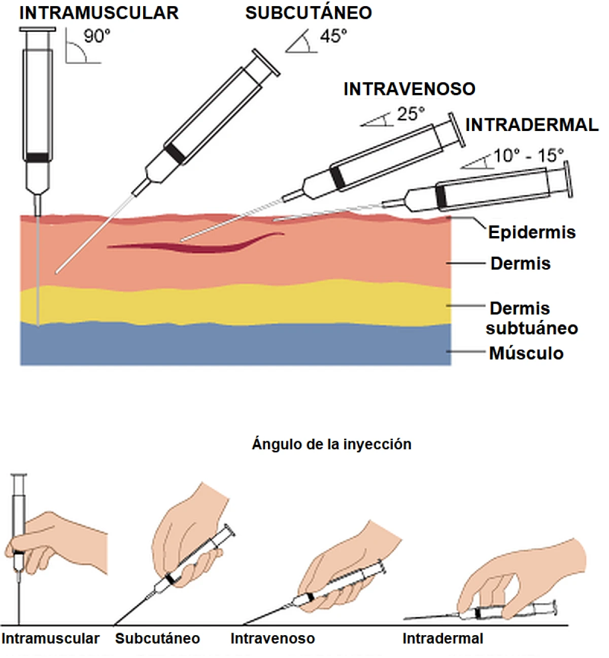 Significado de «inyección hipodérmica o subcutánea»