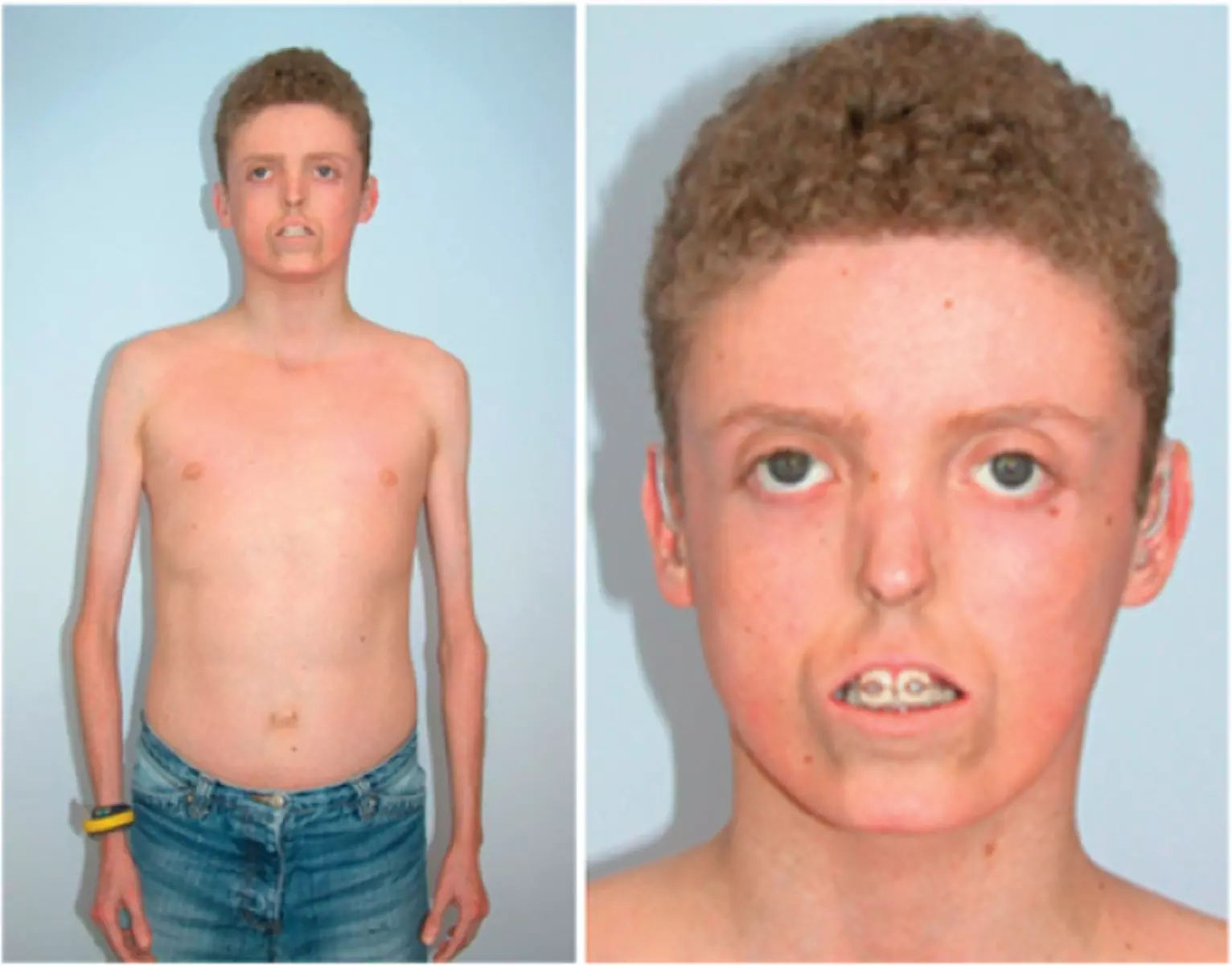 Significado de «lipodistrofia»