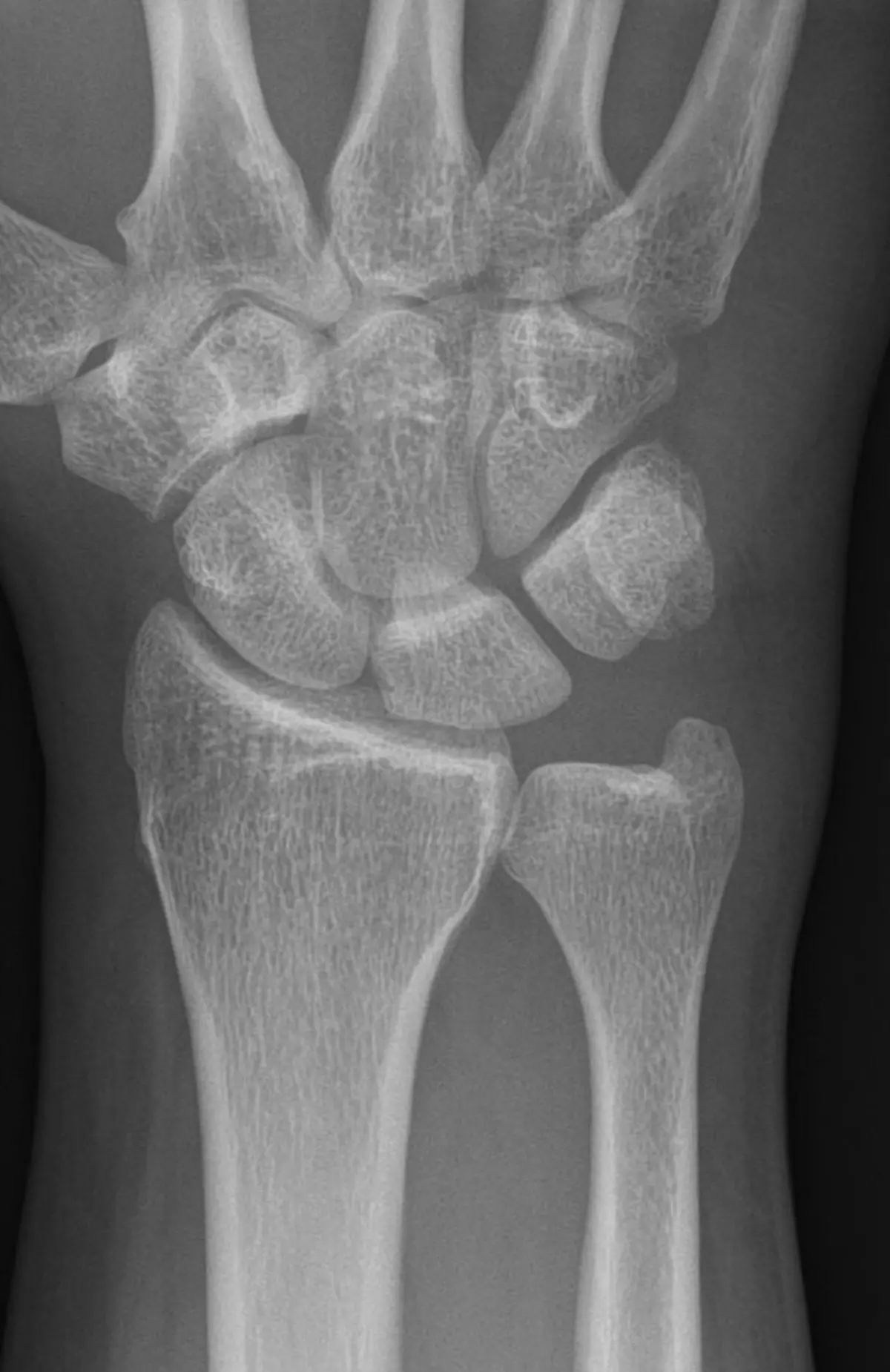 Significado de «pisiforme»