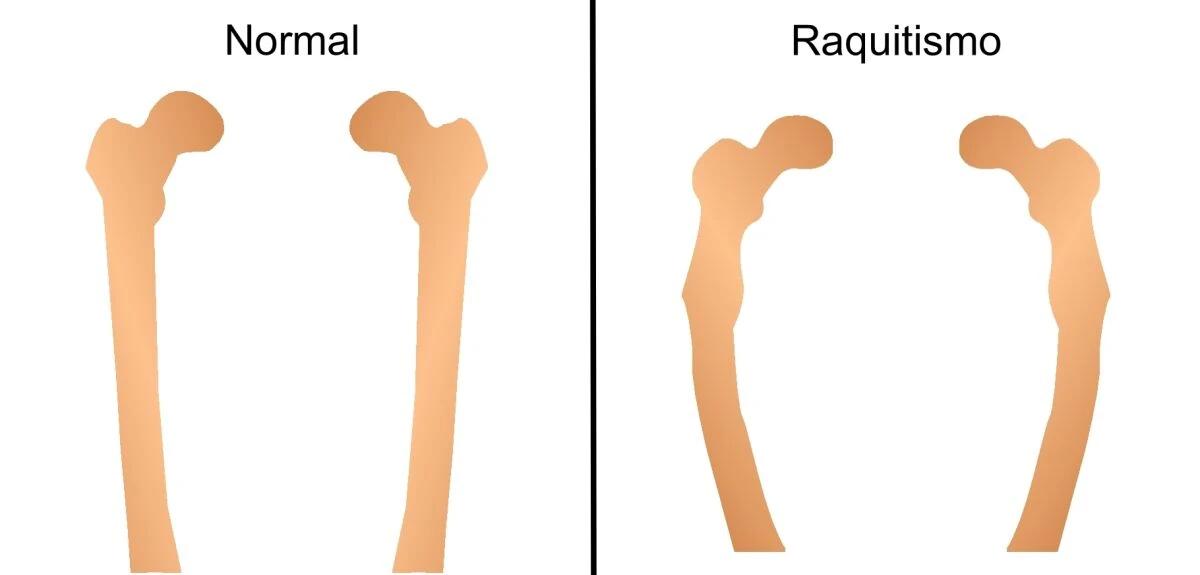 Significado de «raquitismo»