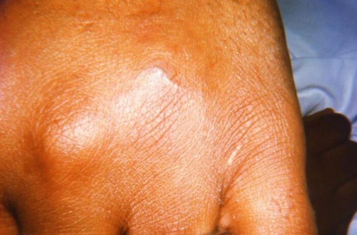 Significado de «sepsis»